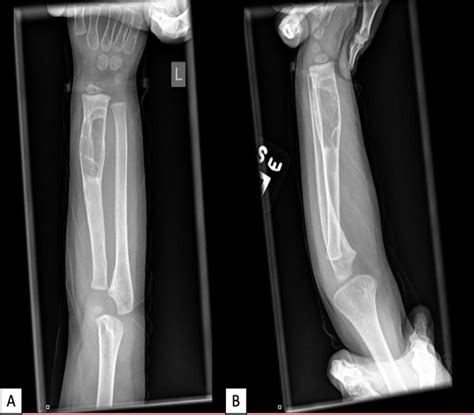 Infantile Fibrosarcoma Of The Bone A Case Report And Literature Review