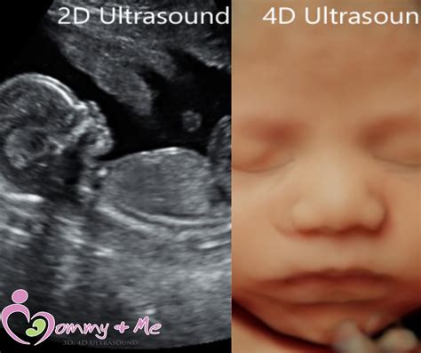 3d4d Ultrasound Are They Safe Things You Need To Know Mommy And Me