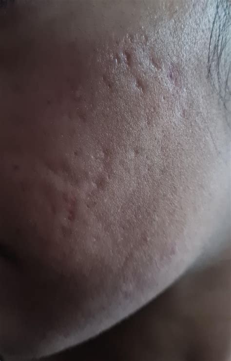 Acne Scars After Accutane Racnescars