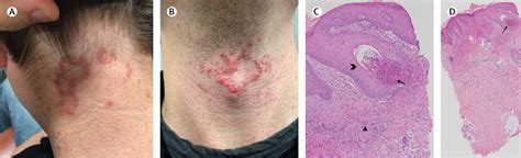 Elastosis Perforans Serpiginosa In A Patient With Wilsons Disease