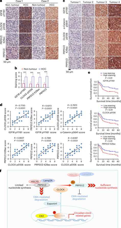 Clock Acetylated Prps12 Predict Human Hcc Aggressiveness Ab Ihc