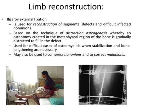 Osteomyelitis Case Report Session Pptx