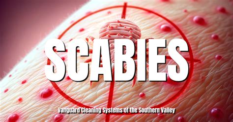 Scabies