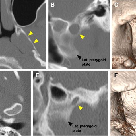 Ossification Of Ligament Types In Descending Order Of Frequency