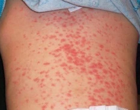 Maculopapular Rash Pictures Causes Treatment Definition Signs