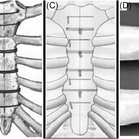 Sternal Closure Techniques A Single Wire Closure Described By Download Scientific Diagram