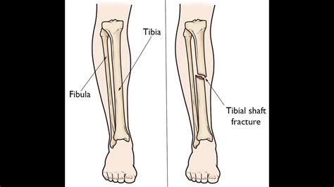 Cpt Code For Distal Fibula Fracture Orif At Crystal Yazzie Blog