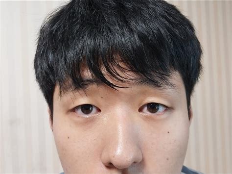 발품후기 제이준성형외과에서 강남언니 1등 성형수술and피부시술 정보앱