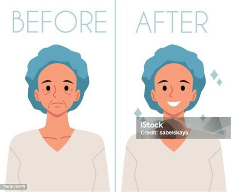 보정 성형 수술 얼굴에 주름이있는 여자 전과 매끄러운 피부를 가진 숙녀 후 벡터 얼굴 리프트 실 봉제 제품에 대한 스톡 벡터 아트 및 기타 이미지 Istock