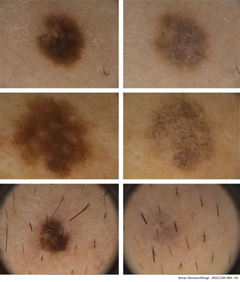 Complete Regression Of Melanocytic Nevi Correlation Between Clinical Dermoscopic And