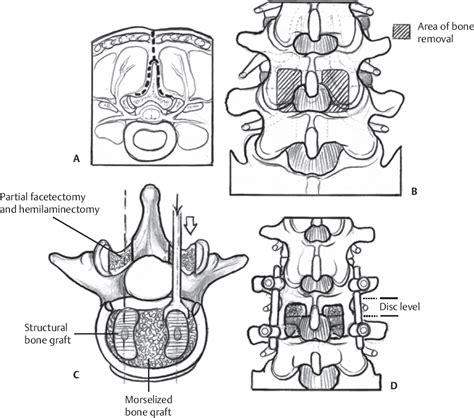 Partial Facetectomy