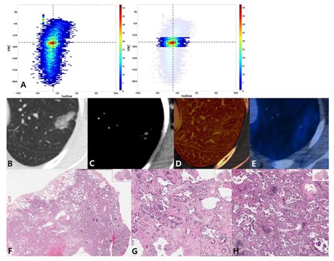 A 54 Year Old Woman With Lung Adenocarcinoma With A 70 Acinar And 30