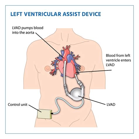 Lvad