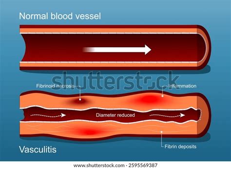 Vasculitis Autoimmune Disease Healthy Blood Vessel Stock Vector