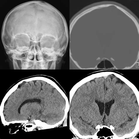 Pediatric Arachnoid Granulations Pediatric Radiology Reference Article Pediatric Imaging