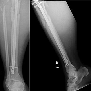 Anteroposterior Radiograph Of The Right Tibia And Fibula Showing