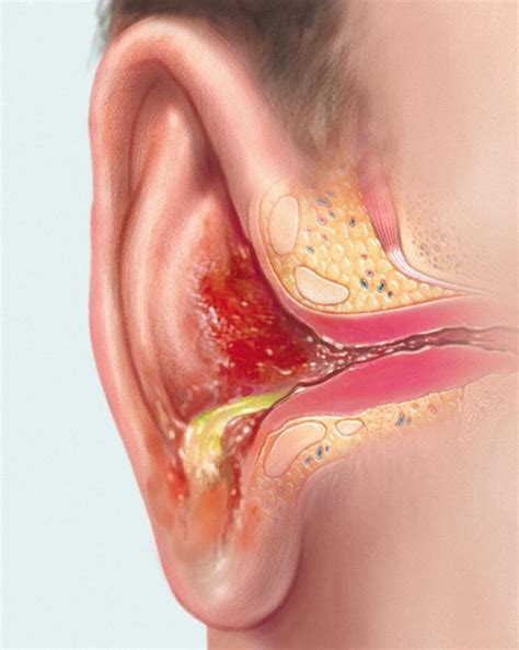 Understanding Otitis Mediaear Infection By Vaishali Sharma Medium