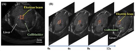 Acoustic Imaging Promises Real Time Dose Measurement For Flash