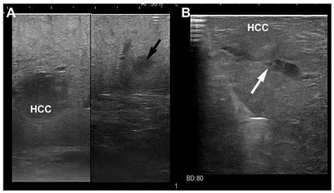 Laparoscopic Microwave Ablation Which Technologies Improve The Results