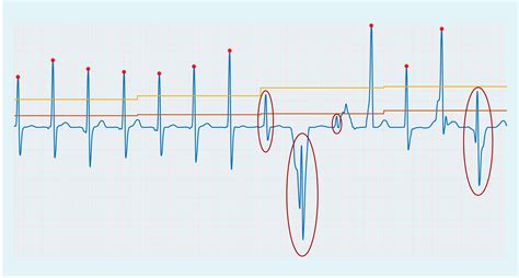 ECG In High Intensity Exercise Dataset Deep Health