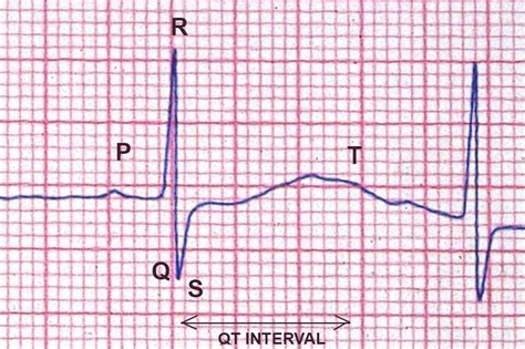 What Does Qt Stand For On An Ecg At Argentina Fields Blog