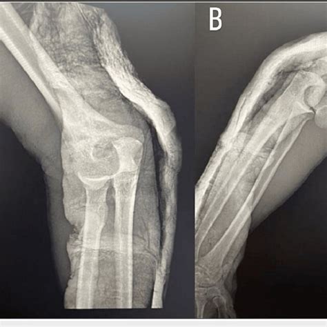 Radiographic View After Closed Reduction Where Joint Congruence Is