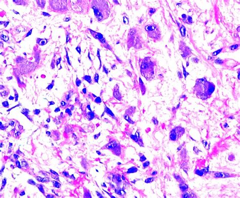 Pathology Outlines Proliferative Fasciitis