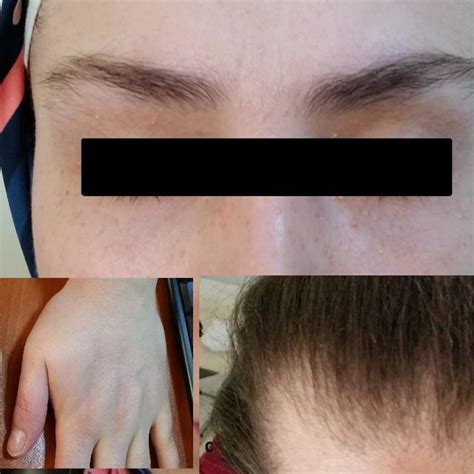 A C Case 1 Multiple Milias On The Face A Follicular Atrophoderma Download Scientific