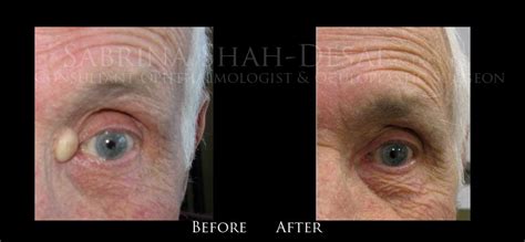 White Bump Under Eye Pictures Photos