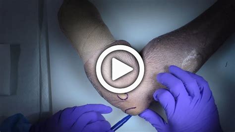 Coronoid Fixation Using A Coronoid Plate With Thomas Goetz Md Acumed