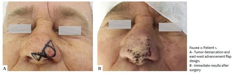 Surgical And Cosmetic Dermatology East West Advancement Flap A Useful Tool To Reconstruct Nasal