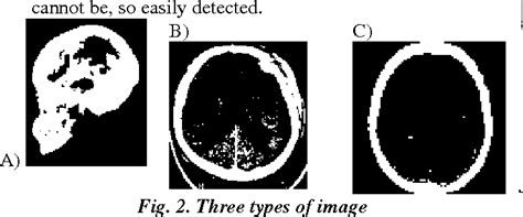 Figure 2 From Skull Fractures Detection By Finite Element Method Semantic Scholar