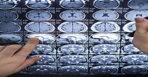 Brain Tumor Segmentation Using Convolutional Neural Networks