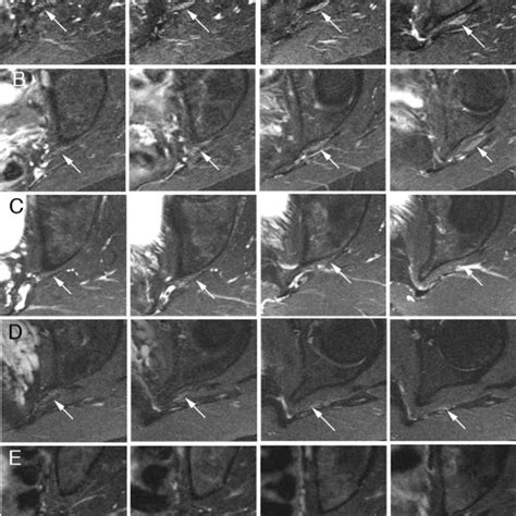 Pudendal Nerve Entrapment Between The Ischial Spine And The Alcock