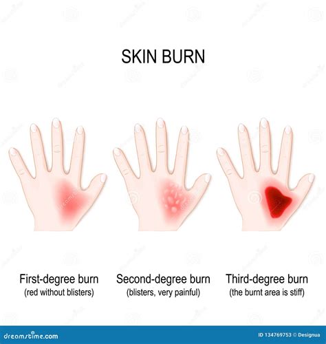 What Is Lye Burn At Lee Ramirez Blog