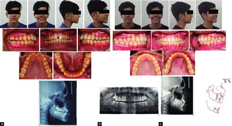 A Post Functional Extraoral And Intraoral Photographs And Lateral