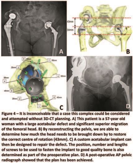 3d Ct A Better Map For Hip Surgery Medicad