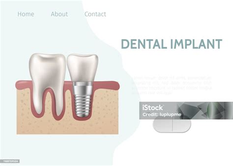 임플란트 및 건강한 치아 및 구조 벡터 그림 치과 진료소 웹 사이트를위한 모든 부품 크라운 어버트먼트 나사가있는 치과 임플란트 구조 금속에 대한 스톡 벡터 아트 및 기타