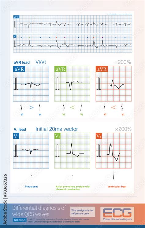 when analyzing the nature of the wide qrs complex some indicators can