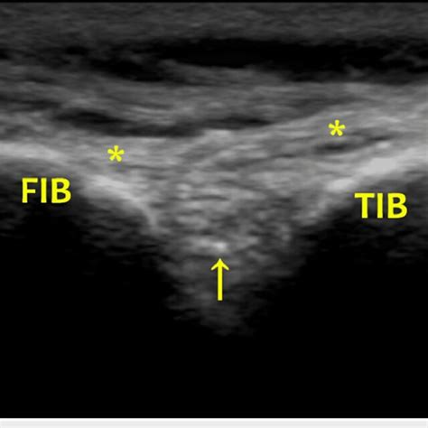 Sonographic View Showing The Needle Tip Within The PTFJ FIB Fibula Download Scientific