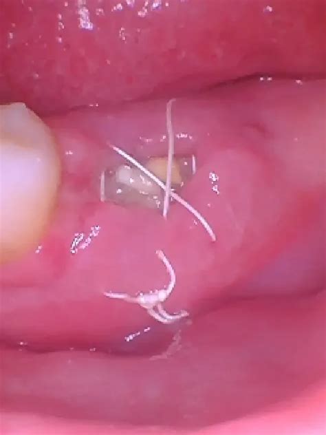 What Does An Extraction Bone Graft Look Like 1 Week After Surgery