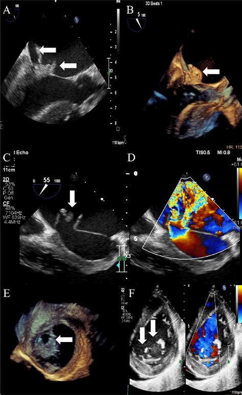 Top Panel 2d A And 3d B Transoesophageal Echocardiography Showing Download Scientific