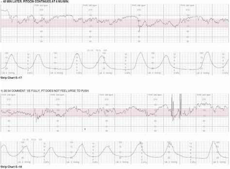 Exercises In Electronic Fetal Monitoring Obgyn Key