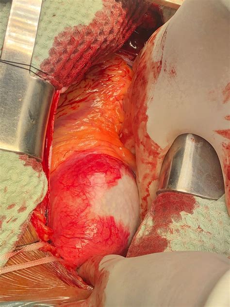 Complex Aorta Surgery Dr Yasir Khakwani