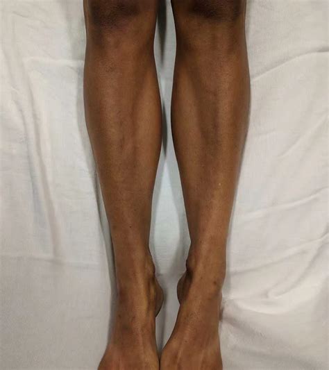 غدد فوق کلیوی انواع بیماری غده فوق کلیه آسانیسم