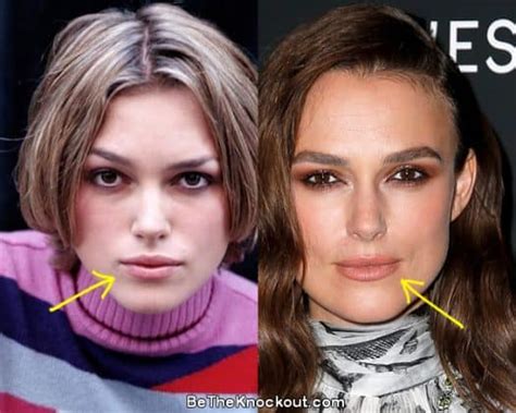 Keira Knightley Plastic Surgery Comparison Photos