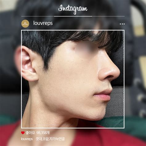 루브르성형외과 처음처럼 자연스럽게 전후사진후기셀카후기