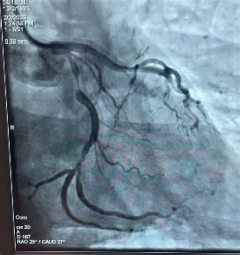 Young Gentleman 3vd Refused Cabg Double Provisinoal Double Kissing Lm To… Saeed Amiripouya