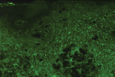 Painful Oral Groin And Scalp Lesions In A Young Man Mdedge