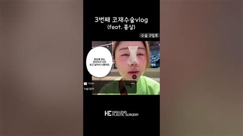 코재수술 코성형 코재수술 브이로그 자가늑연골 화려한 코끝 자려한 라인 직반라인 코 Vlog Shorts Youtube